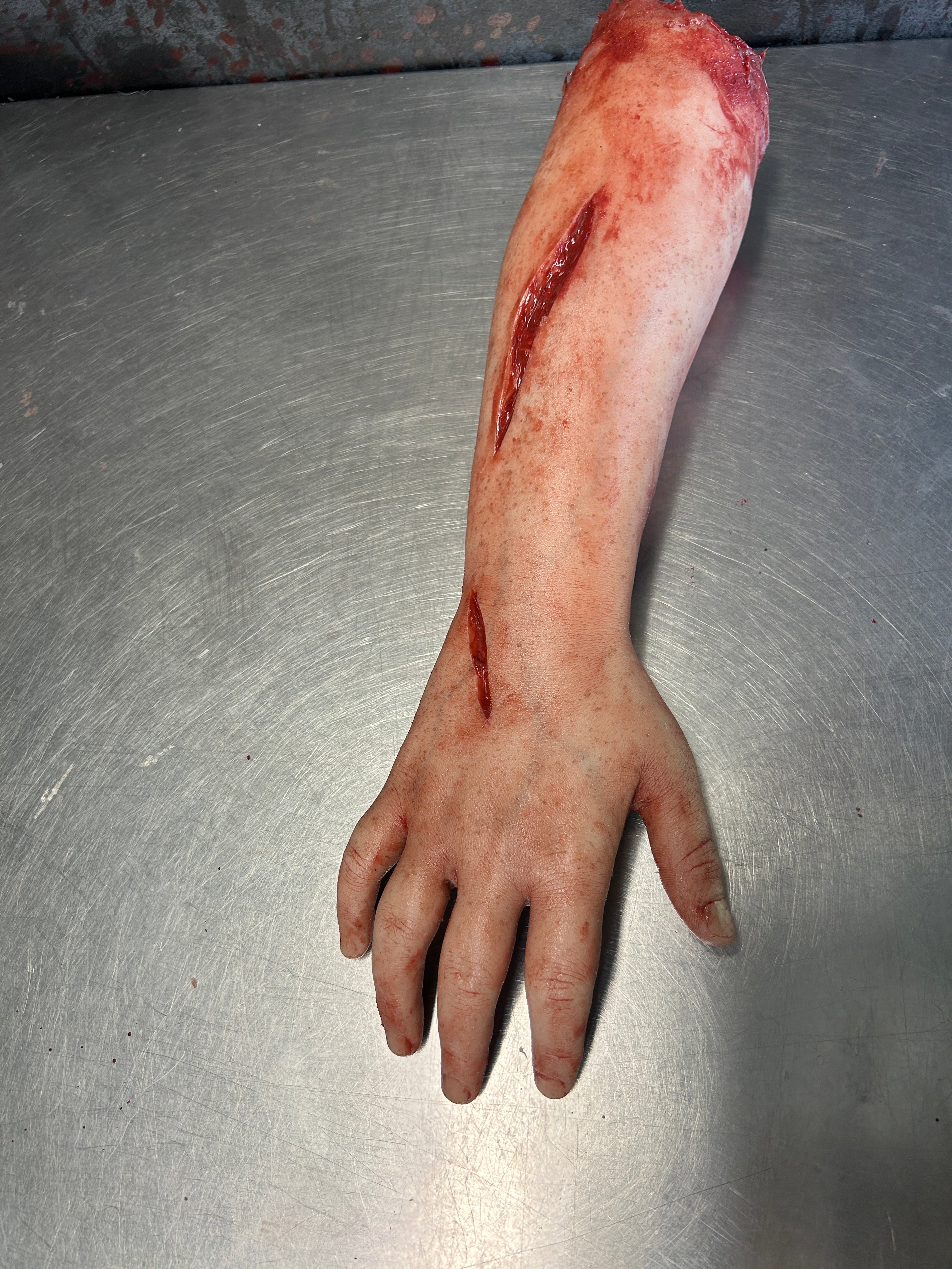 Broken Arm Bone Sticking Out